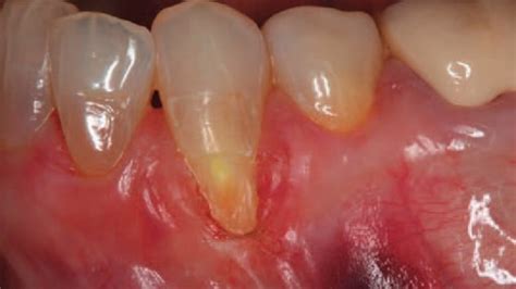 Root Coverage Fig 1a Decisions In Dentistry