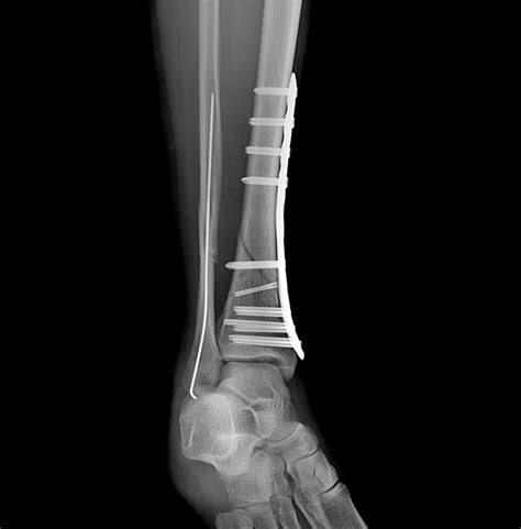 비골 골절 다친 부위가 빨리 낫지 않을 땐 네이버 블로그