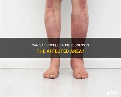 Can Varicocele Cause Redness In The Affected Area Medshun