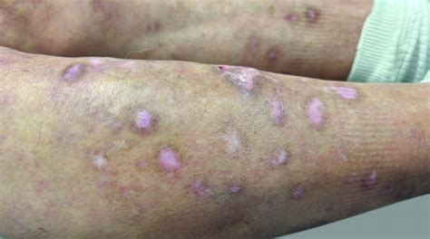 Dupixent® Dupilumab Results In 18 Years