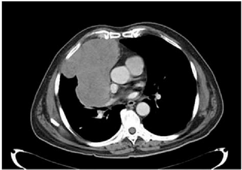 Axial Cect Chest Mediastimal Window Shows A Soft Tissue Density Mass