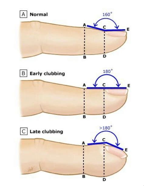 Pinky Anatomy Ring Finger Diagram Finger Anatomy Nail Abnormalities