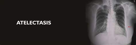 Atelectasis መንስኤዎች ምልክቶች ምርመራ እና ህክምና