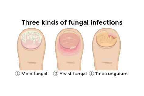 Types Of Nail Fungus Symptoms Causes And Treatment