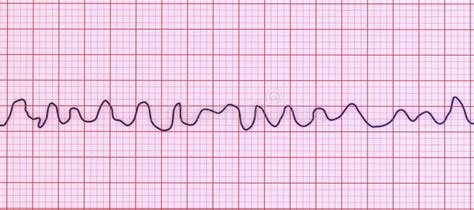 Ventricular Fibrillation Ecg