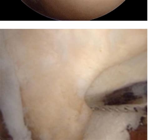 Figure 2 From Heterotopic Ossification Of The Shoulder After Arthroscopic Rotator Cuff Repair A