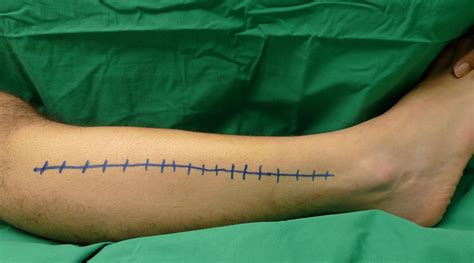 Dilemmas In Compartment Syndrome DR BINU SASIDHARAN MBBS D Ortho M S Ortho