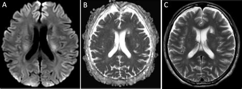 Magnetic Resonance Imaging Brain A Diffusion Weighted Imaging DWI B Download Scientific