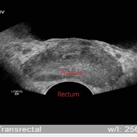 The Prostate Measures 45 × 35 × 25 Cm With An Estimated Volume Of 21