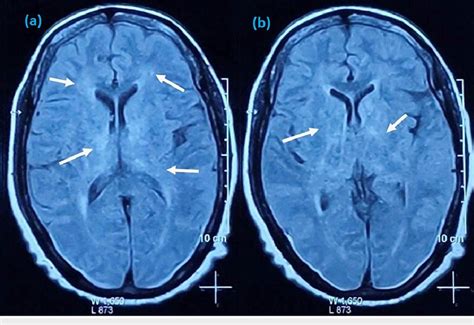 Ct Brain Showing Extensive Calcifications In Bilateral Globus Pallidi