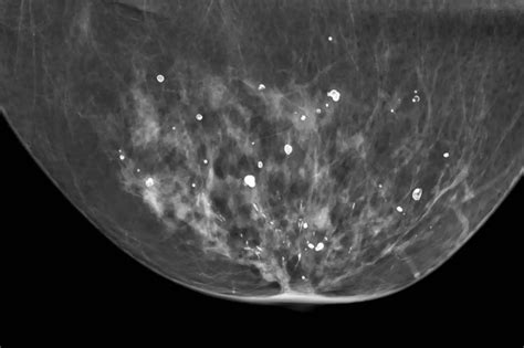What Is Calcification In The Breast Is It Truth