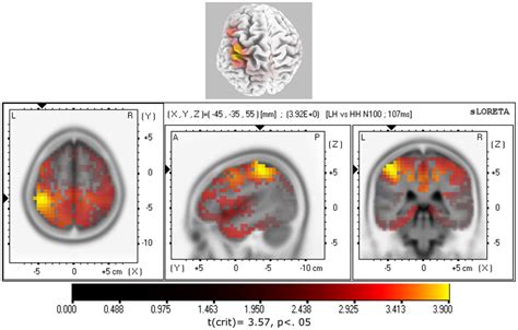 Sloreta Parametric Maps Comparing N100 Waves To Pulse Alone Pa Trials