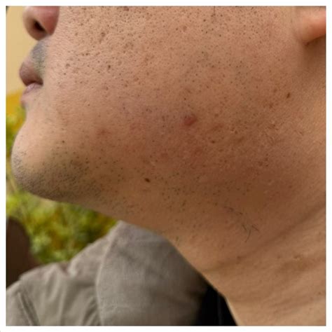 갑자기 붉은여드름 올라올 때 안짜지는 딱딱한 화농성여드름 어성초비누 케어 네이버 블로그