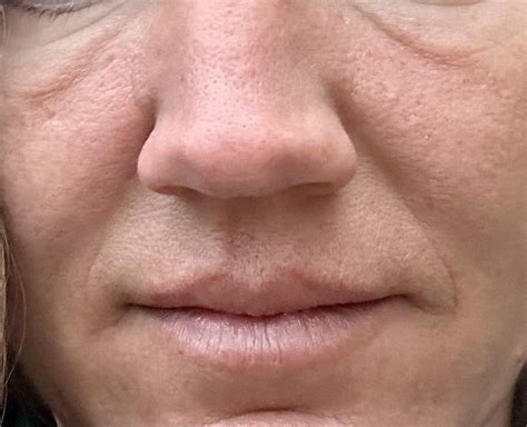 Misc Hyperpigmentation On Perimeter Of Lips Rskincareaddiction