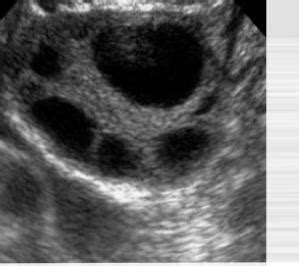 Pcos Detection Object Detection Dataset And Pre Trained Model By Project Pcos