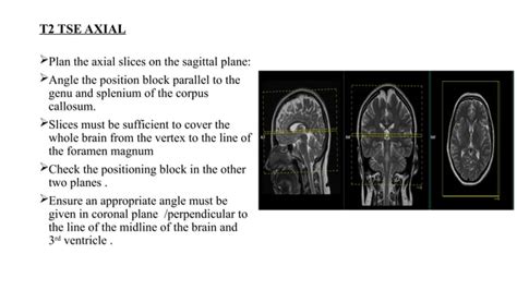 10 Mri Brain Epilepsy Seizure Protocol 2 Pptx