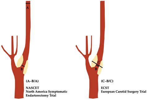 Life Free Full Text Quantifying Carotid Stenosis History Current Applications Limitations