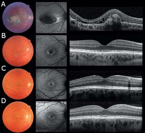 Macular Dystrophy