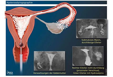 Fallopian Tube Diagnostics • Kinderwunschteam Berlin