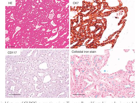 Figure From Classification Of Solid Renal Tumor With Oncocytic Eosinophilic Cytoplasm Is
