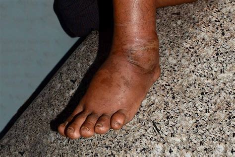Swollen Ankles Feet And Legs Oedema Nhs