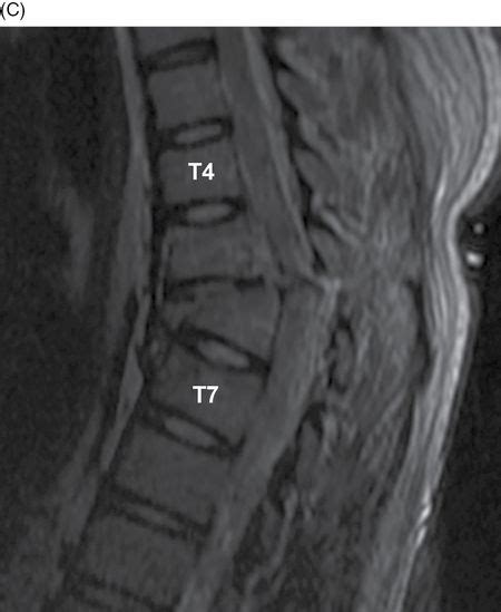 T5 Fracture