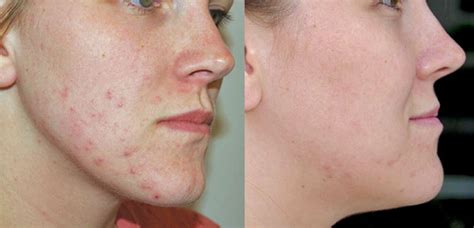 How Often To Use Red Light Therapy Experts Advice Heliotherapy