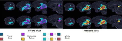 Figure 3 From Multiclass Tumor Segmentation From Brain Mris Using Garu