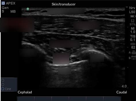 Pec 1 And 2 Serratus Anterior Plane Nerve Blocks Diagram Quizlet