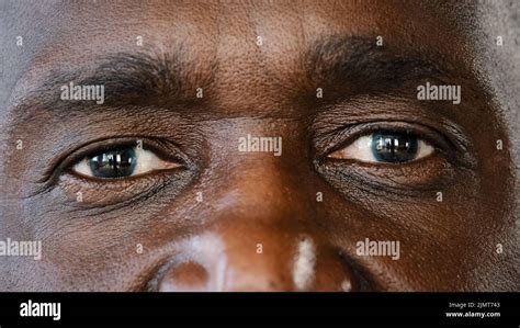 Furrowed Brow Wrinkles