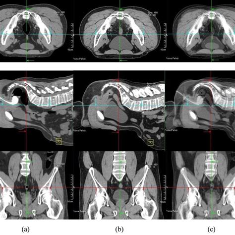 Comparison Of Simulation Ct And Ctor After Image Registration For Download Scientific Diagram