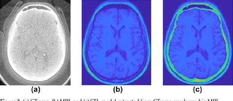 Figure 1 From Development Of A Convolutional Neural Network Based Skull Segmentation In Mri