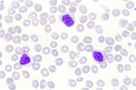 Nk Cell Large Granular Lymphocyic Leukemia Nk Lgl Chronic Nk Cell Lymphocytosis