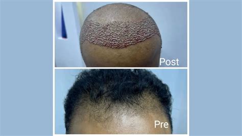 Forehead Reduction In Hurghada Book Now Nadara Center