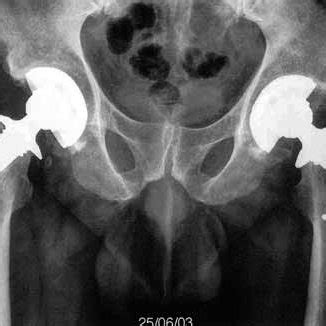 This Patient Aged Years Underwent Bilateral TPP At The Same Sitting Download Scientific