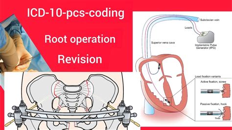 Ip Drg Training Icd 10 Pcs Coding Root Operation Revision Youtube