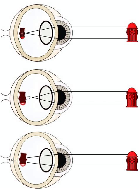 Ray Diagrams Showing Emmetropia Proper Focusing Of Images On The