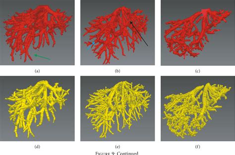 Figure 1 From An Improved Fuzzy Connectedness Method For Automatic Three Dimensional Liver