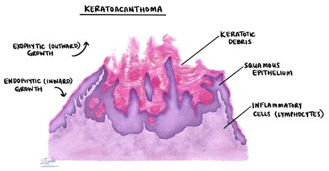 Keratoacanthoma