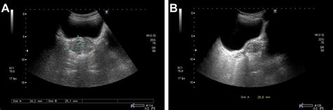 Ultrasound Detected A Non Uniform Hypoechoic Nodule About 34 Mm × 25