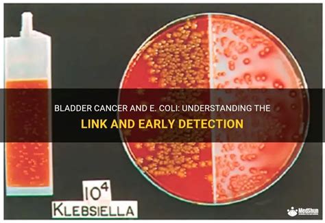 Bladder Cancer And E Coli Understanding The Link And Early Detection