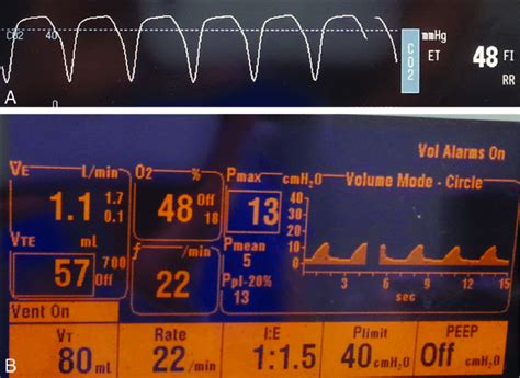 A Abnormal Wave Form Of Capnography Monitoring B Ventilator Download Scientific Diagram