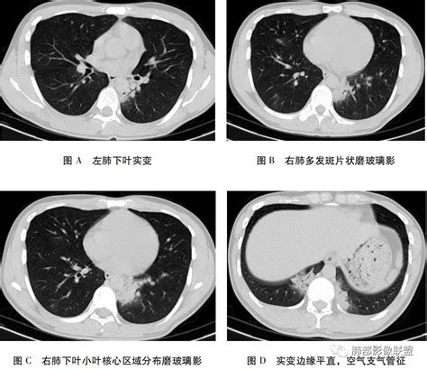 【病例】新冠肺炎进展期3例ct征象分析 影像ppt