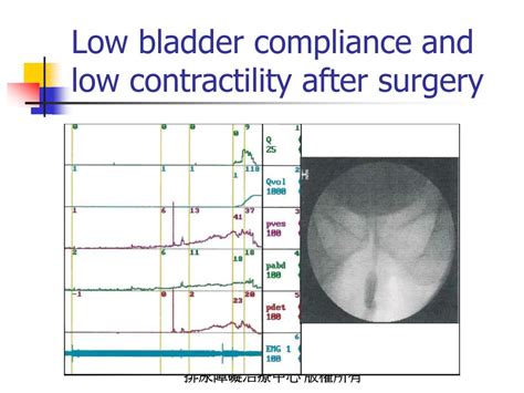 Ppt Urinary Tract Infection And Urodynamics Powerpoint Presentation