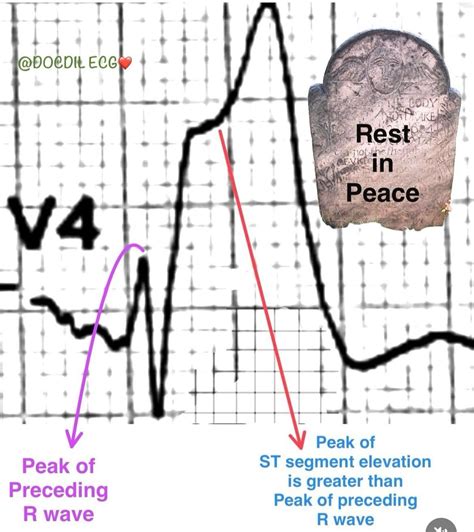 Beware Of The Tombstone Ecg 👇 Lisa Lewandowski