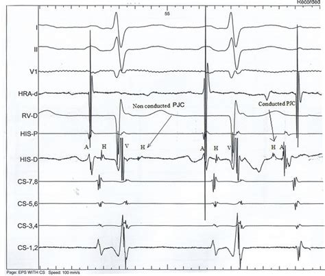 Intracardiac Electrogram Demonstrated Isolated His Signals Followed By Download Scientific