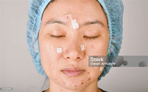 얼굴 피부 문제 성인의 여드름 질환 흰 머리 여드름으로 여자 얼굴을 닫고 기름기가 많은 얼굴 여드름 레이저 치료 후 발적 화상과