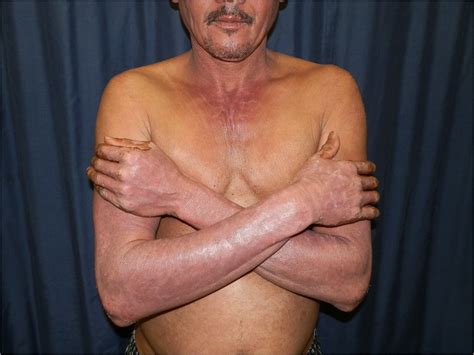 Frontiers Hiv Associated Photodermatitis In African Populations