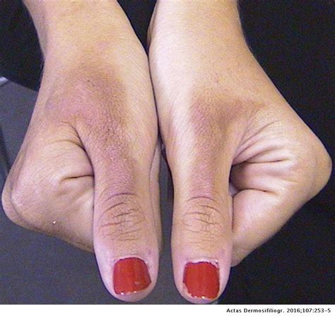 Acropigmentation Of The Dorsum Of The Hands From Preparing Mojitos A