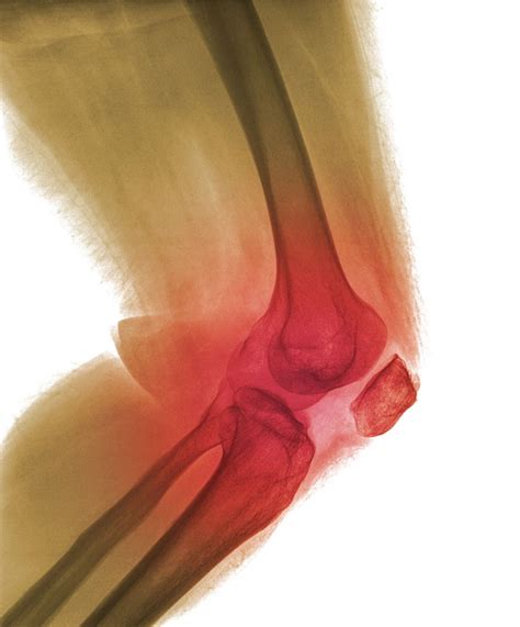 New Treatment Target Could Halt Knee Cartilage Degeneration